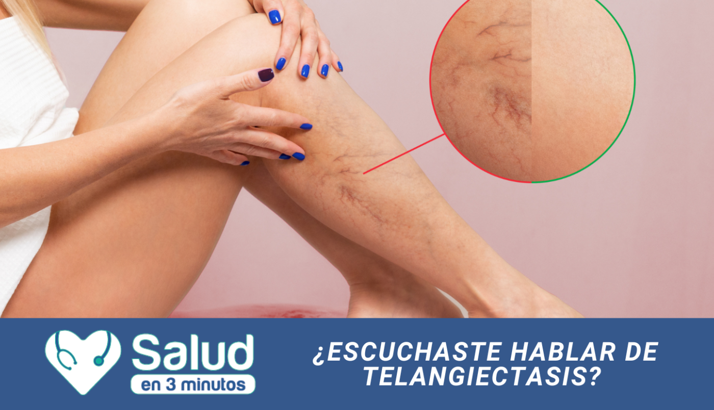 Telangiectasias: un problema varicoso muy común | Telefe Córdoba